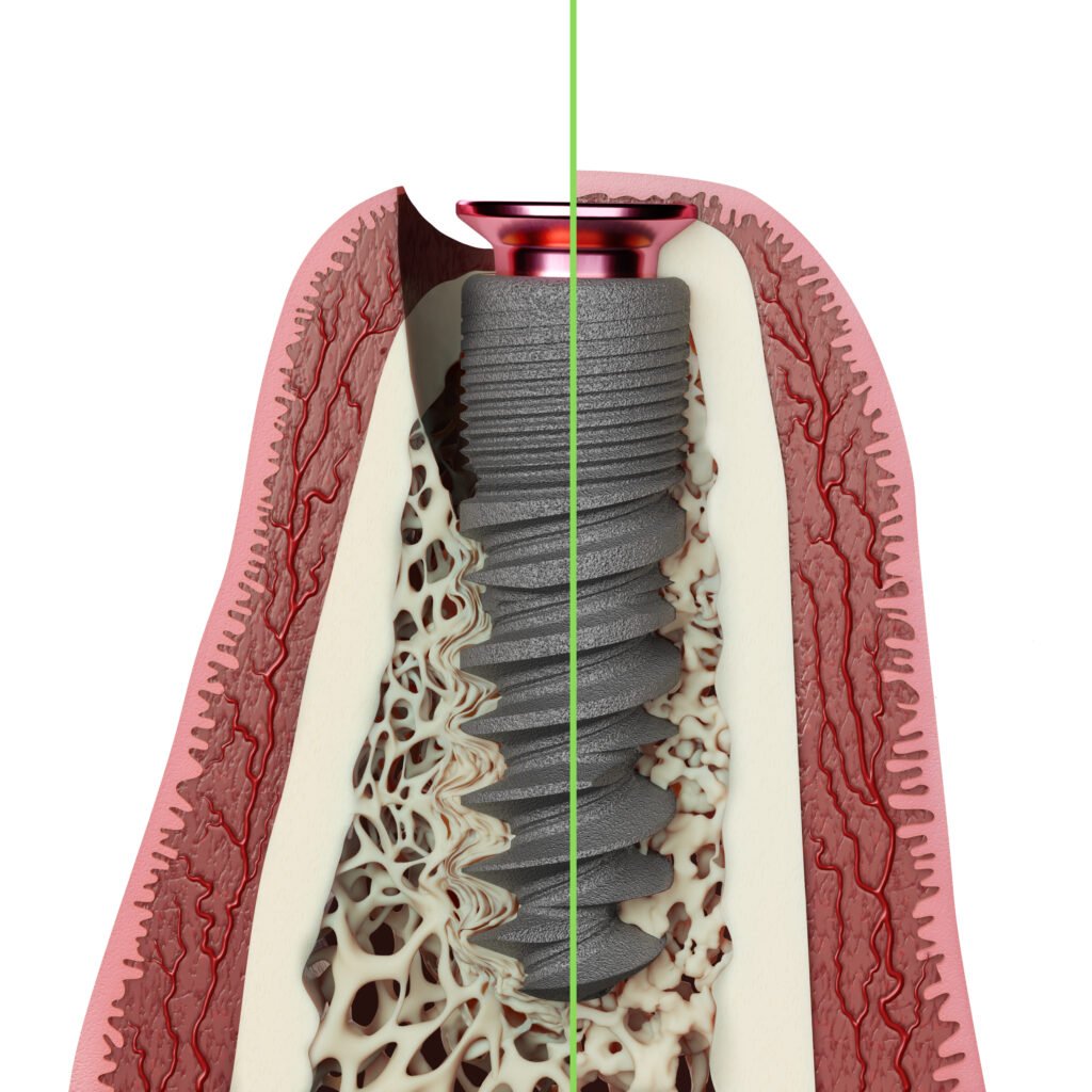 Trade-In – Pro-TRATE, Implants ROOTT