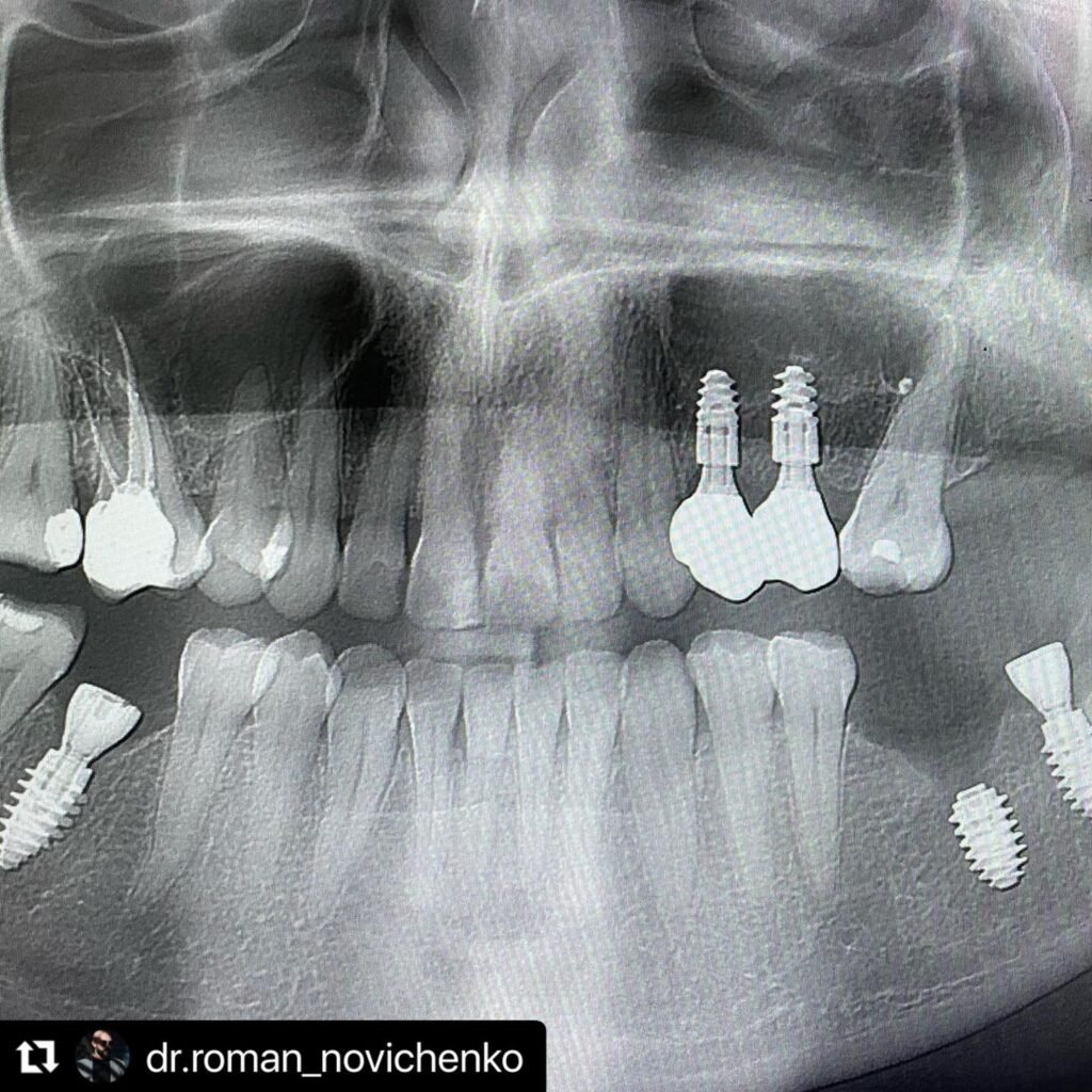ROOTT R – Pro-TRATE, Implants ROOTT