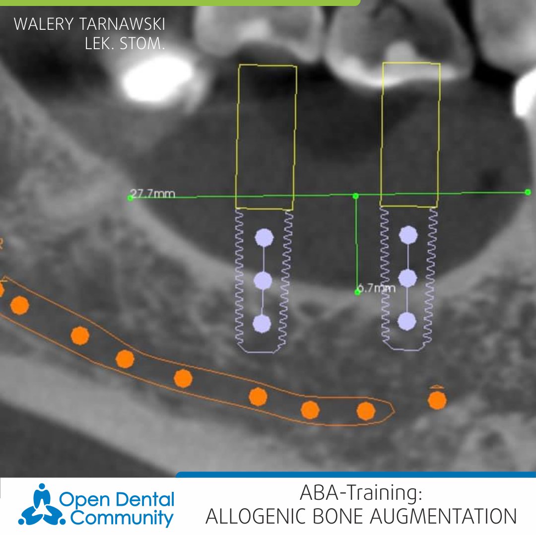 ROOTT R – Pro-TRATE, Implants ROOTT