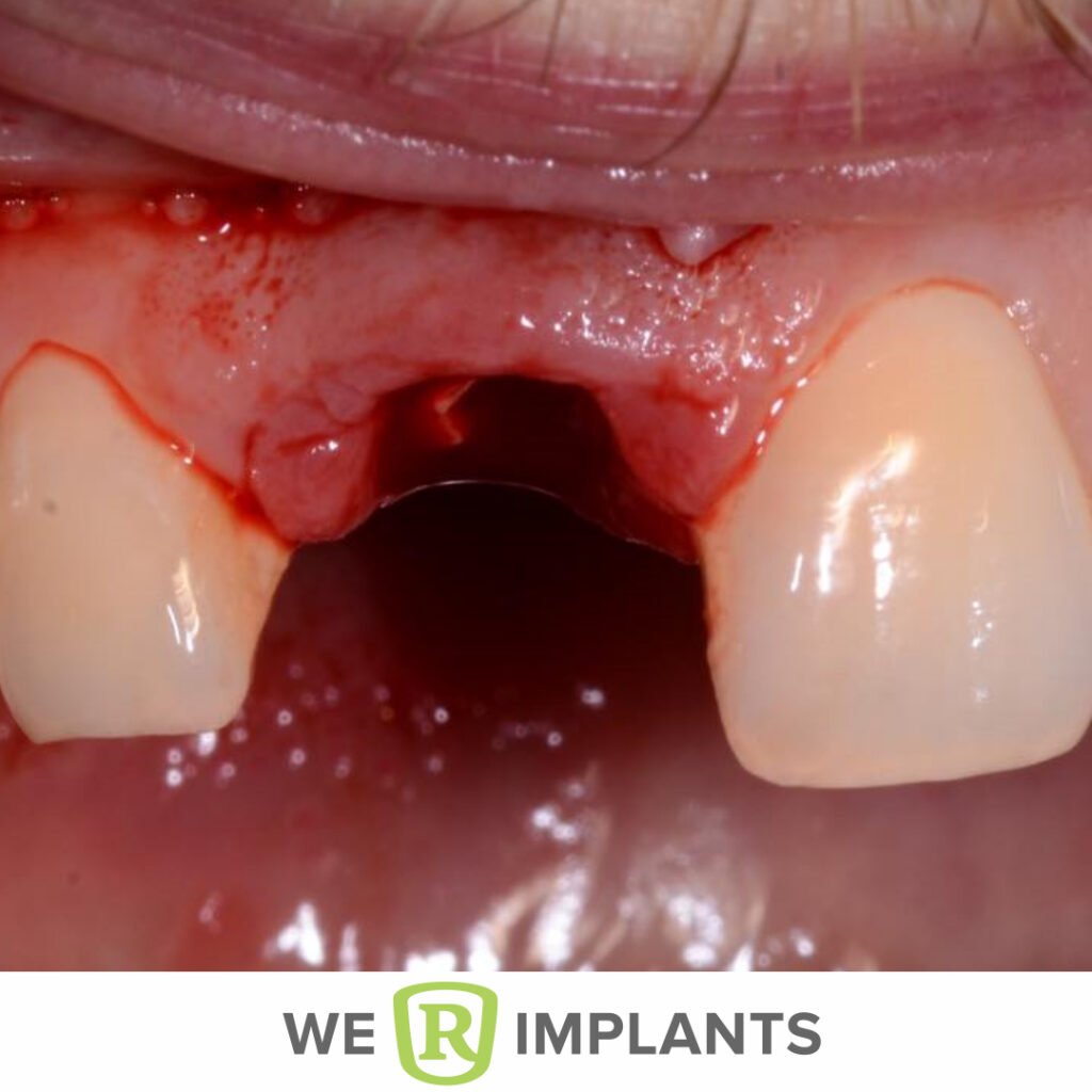 ROOTT R – Pro-TRATE, Implants ROOTT